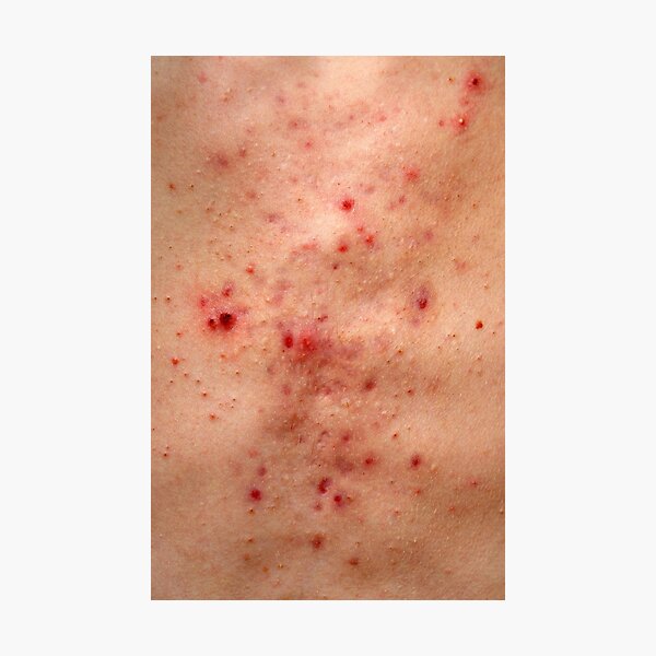 Lámina fotográfica «Daño en la piel con acné, mancha roja en el pecho ...
