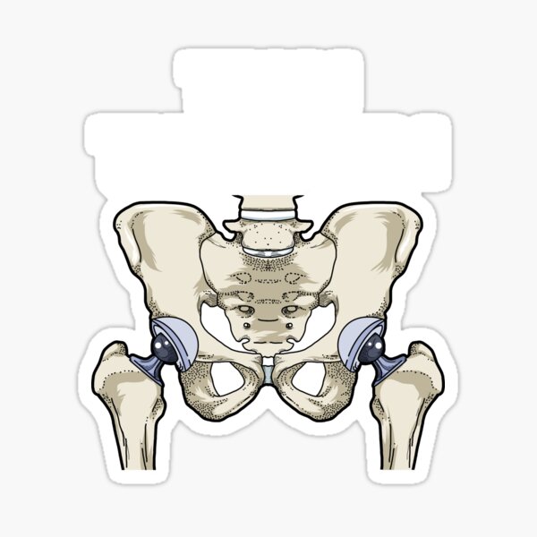 "Hip Surgery Recovery Gifts Women Men Hippie Hip Replacement" Sticker ...