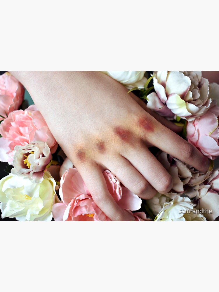 "Bruises" Sticker for Sale by sam-andthe | Redbubble