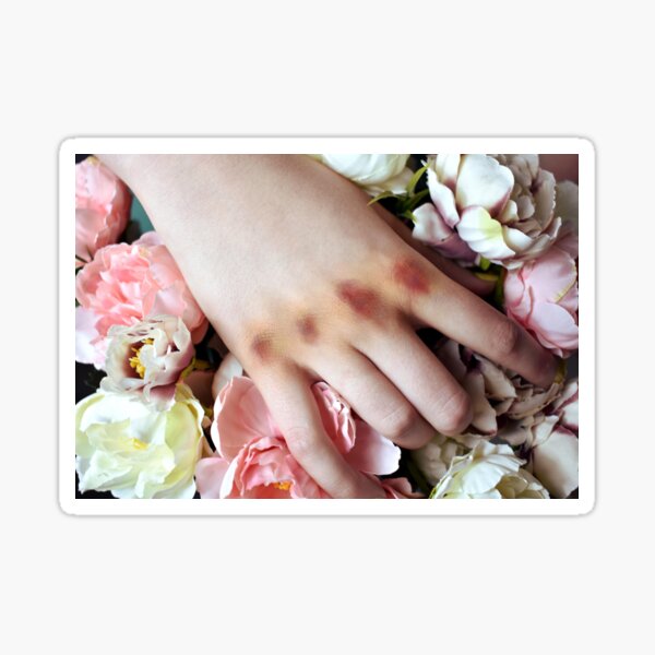 "Bruises" Sticker for Sale by sam-andthe | Redbubble