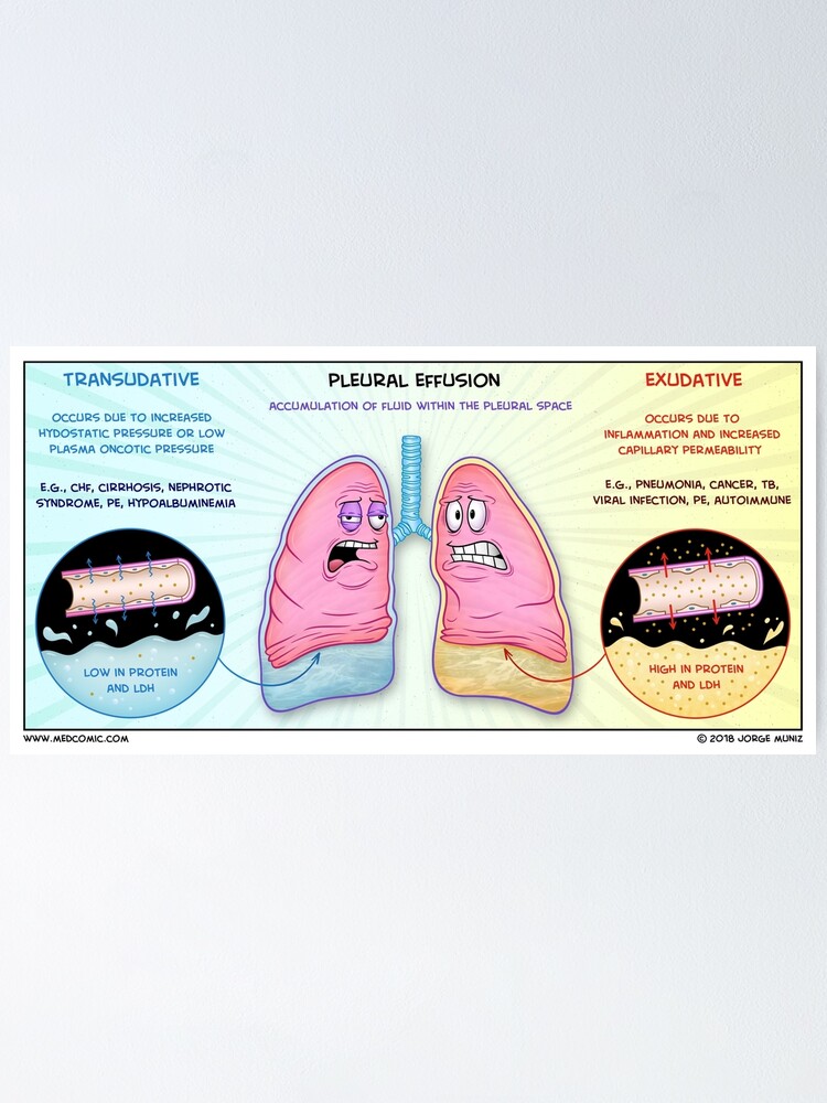 "Pleural Effusions: Transudate vs. Exudate" Poster for Sale by Medcomic ...