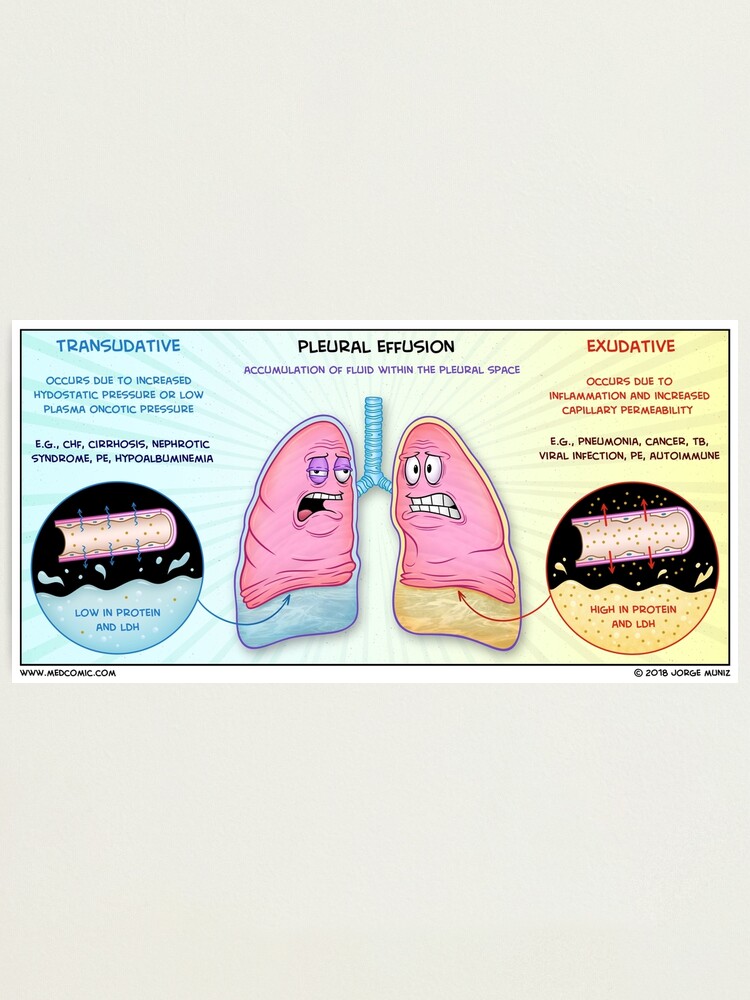 "Pleural Effusions: Transudate vs. Exudate" Photographic Print for Sale ...