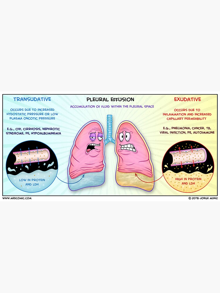 "Pleural Effusions: Transudate vs. Exudate" Sticker for Sale by ...