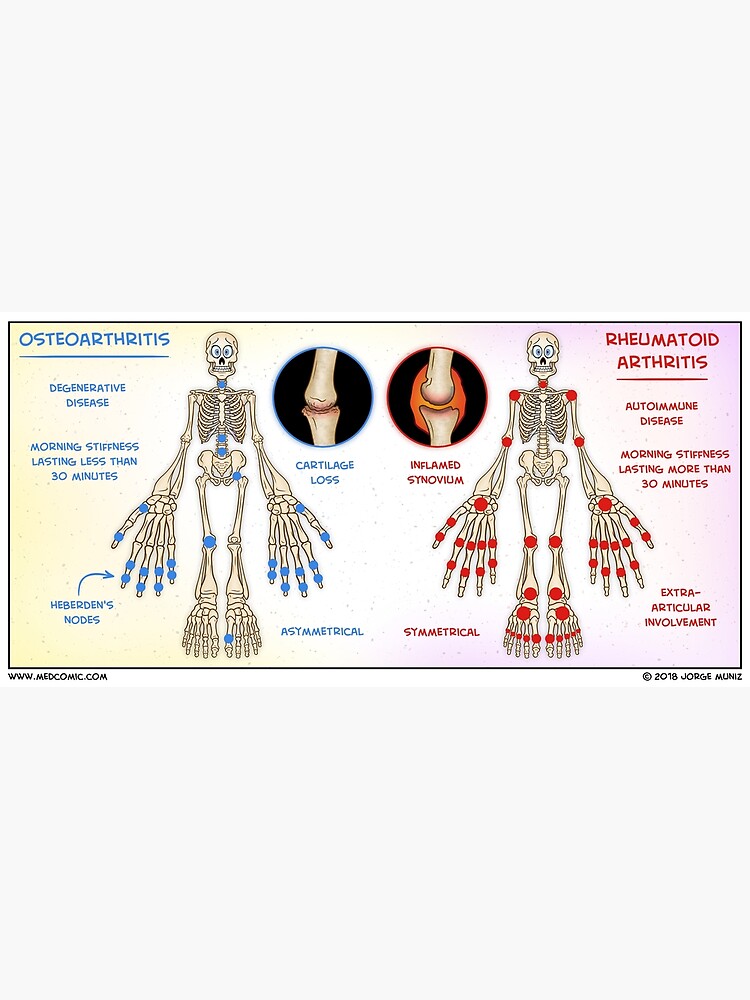 "Osteoarthritis vs. Rheumatoid Arthritis" Poster by Medcomic | Redbubble