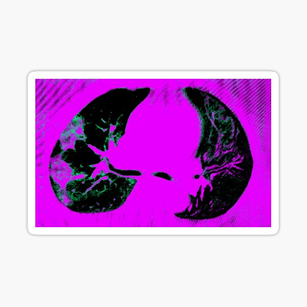 "Chest CT Scan of Patient with Coronavirus Infection" Sticker for Sale ...