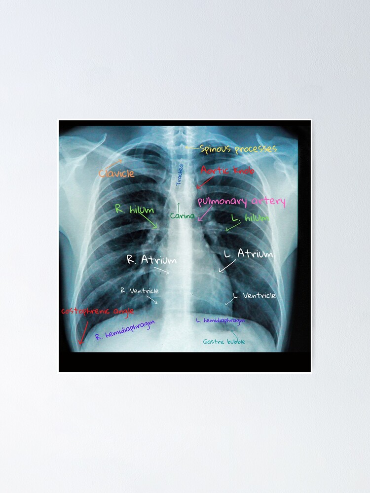 "Chest X-ray with labels" Poster for Sale by TheWhiteRhyno | Redbubble