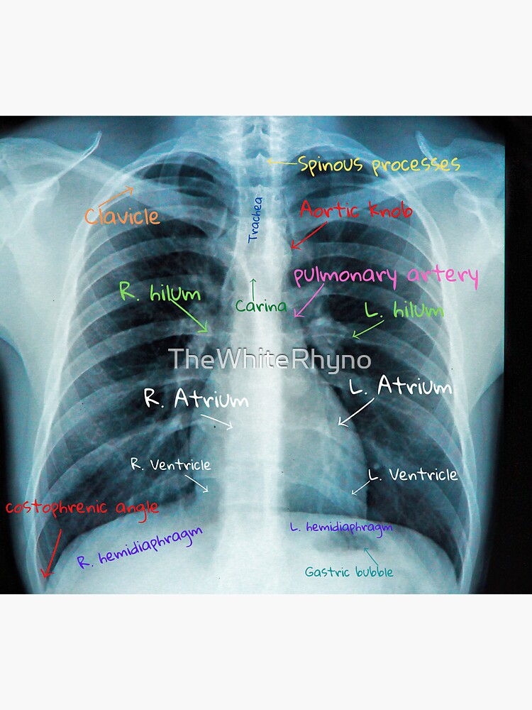 "Chest X-ray with labels" Sticker for Sale by TheWhiteRhyno | Redbubble