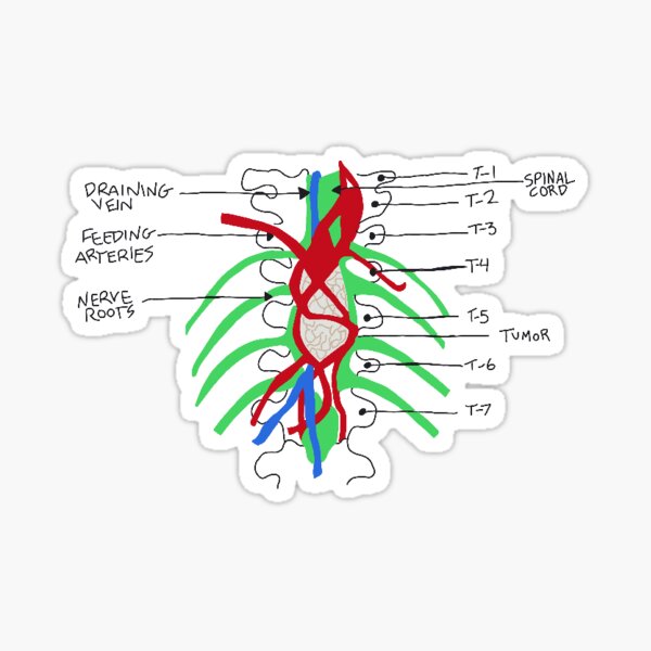 "Tumor on the wall" Sticker for Sale by Hjbonnot | Redbubble