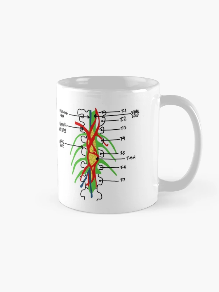 grey s anatomy tumor Coffee Mug for Sale by alamovinyl Redbubble