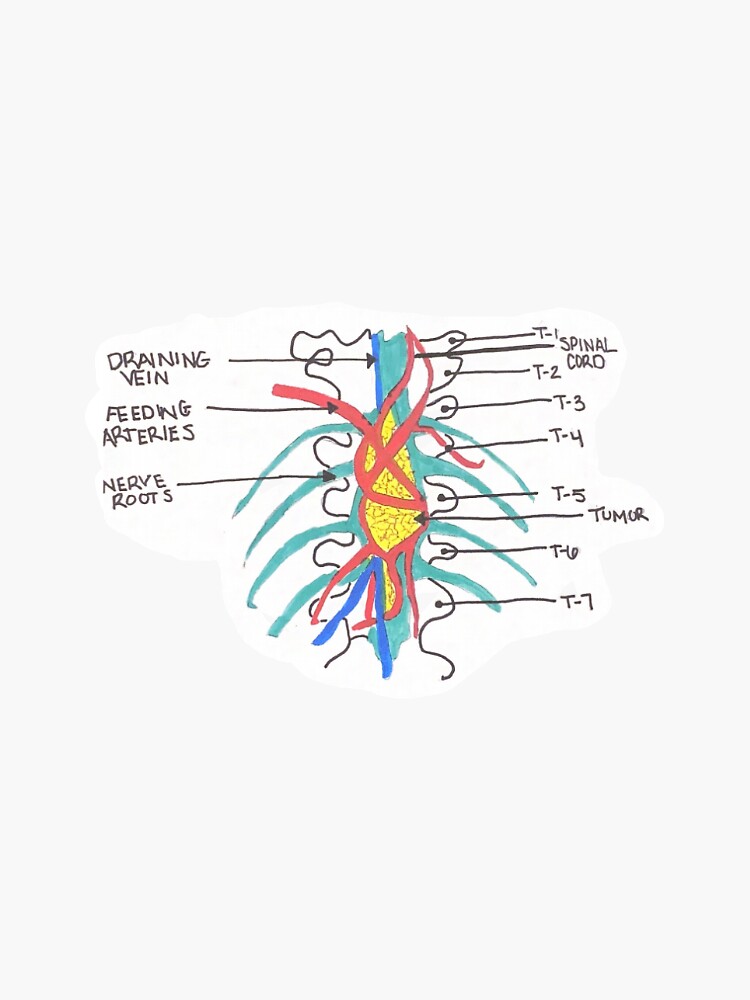 "tumor on the wall" Sticker for Sale by hehjulie | Redbubble