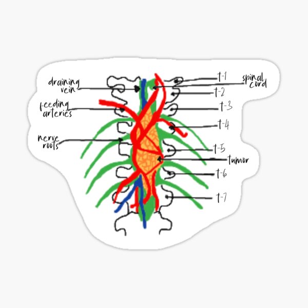 "tumor on the wall" Sticker for Sale by emily86701 | Redbubble