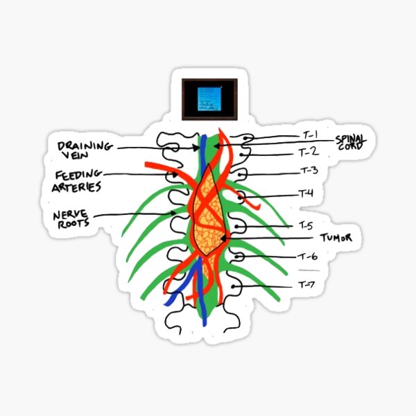 "Tumor on the Wall" Sticker for Sale by Bellat543 | Redbubble