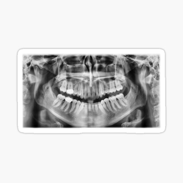 "x-ray" Sticker for Sale by lucasbecker | Redbubble