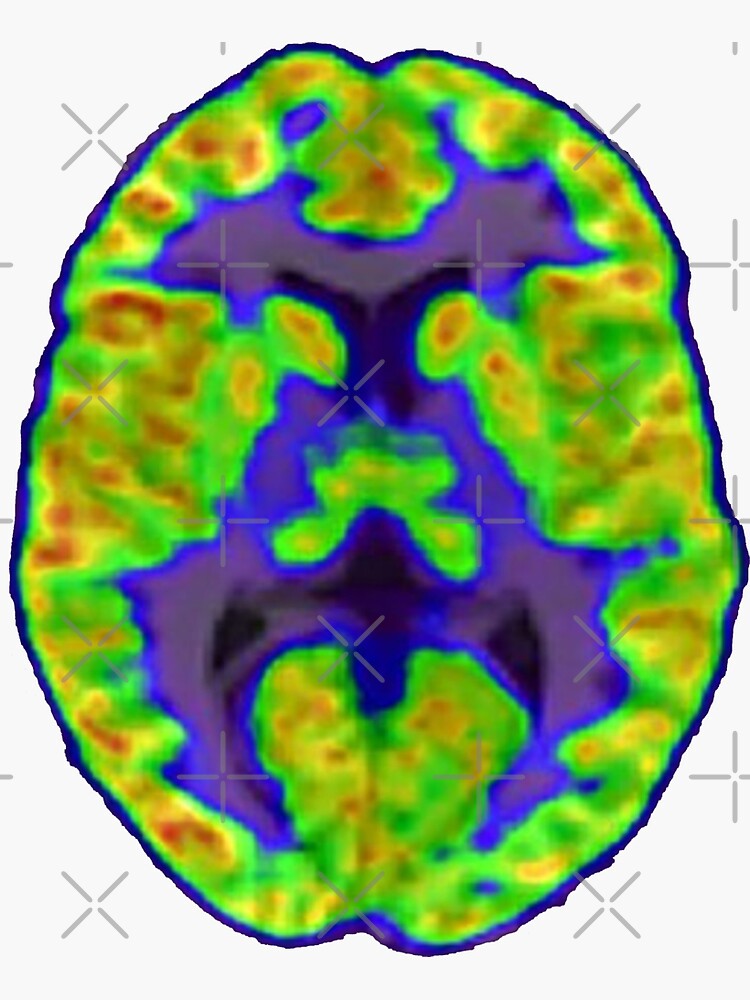 "PTSD Brain Scan" Sticker for Sale by noahmcg | Redbubble