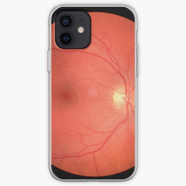 Optometry iPhone Cases | Redbubble