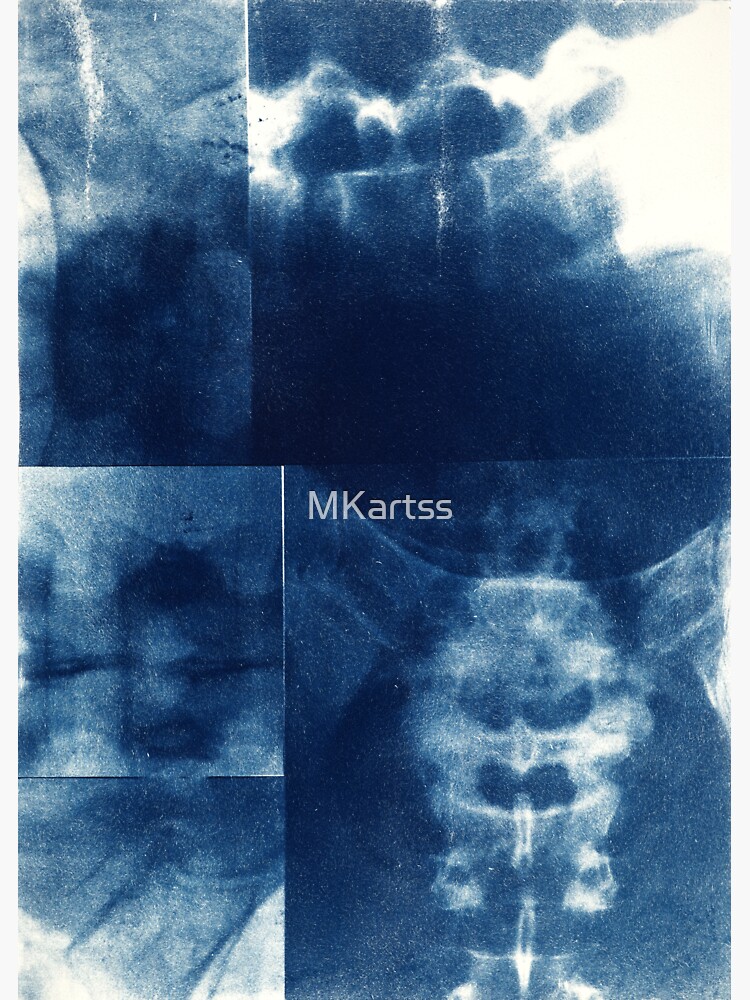 "Cyanotype Art Prints Graphic Art - X-rays Skeleton" Sticker for Sale ...