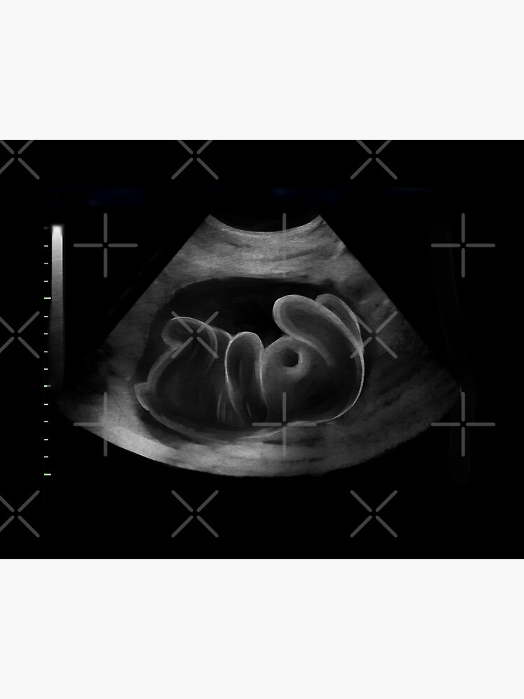 Bunny Rabbit Sign Ultrasound Ultrasound Guided Block Of The Sciatic