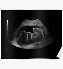 Ultrasound: Posters | Redbubble