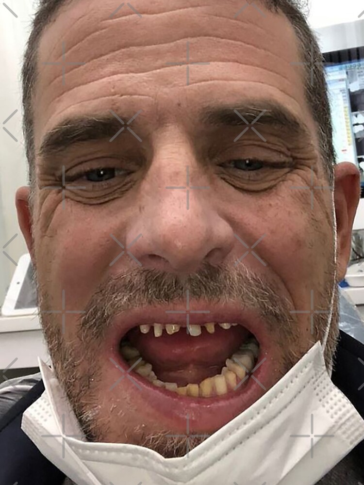 "Hunter Biden Cracked Teeth Smile" iPhone Case for Sale by DirtySanchai ...