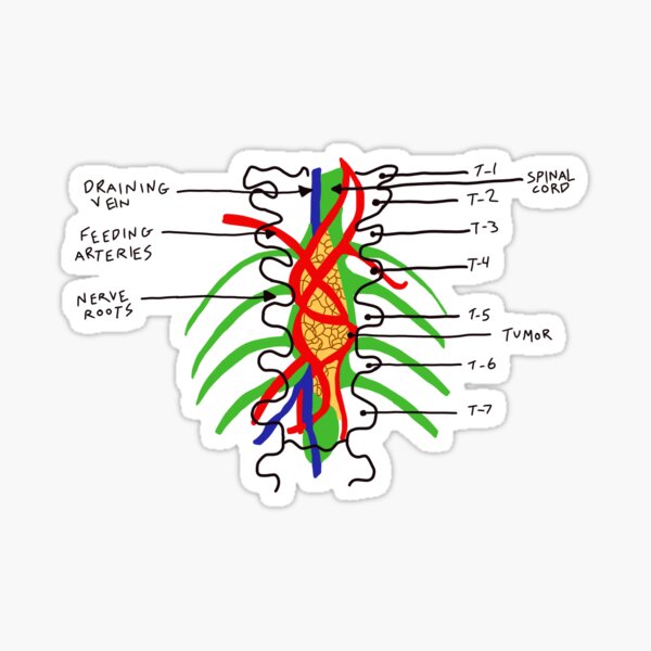 "Tumor on the Wall " Sticker for Sale by courtroses1 | Redbubble