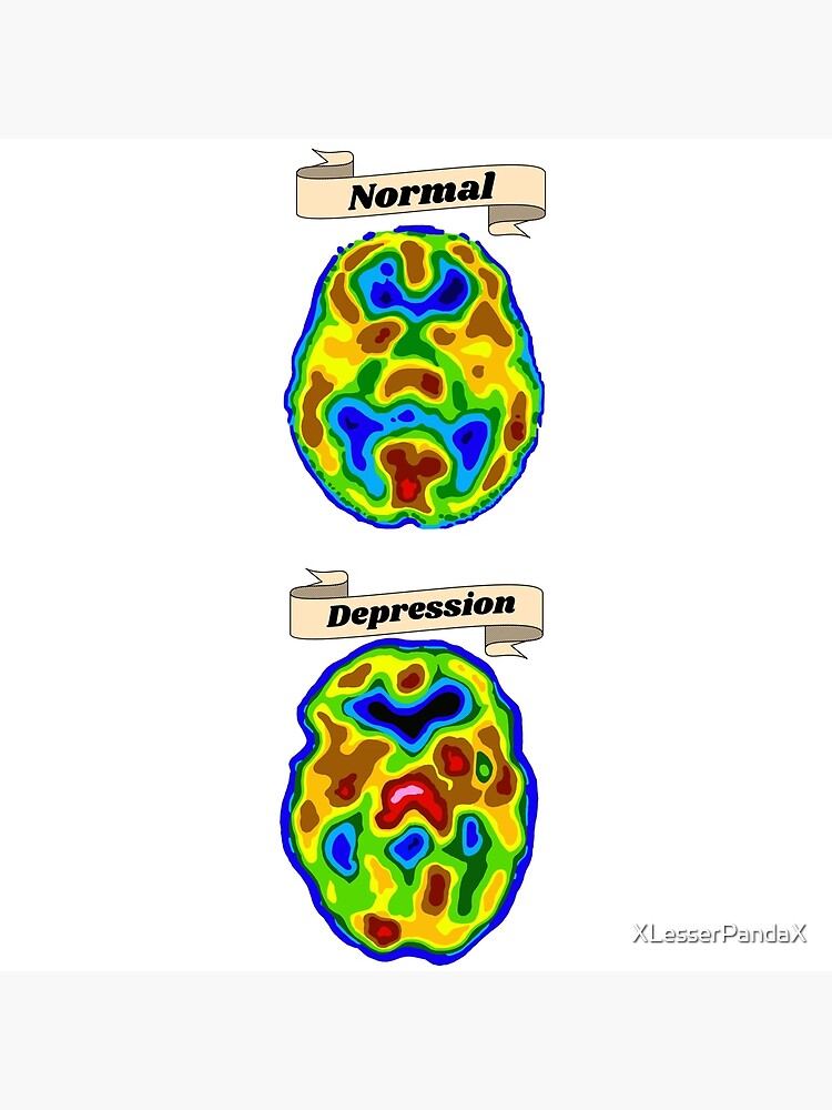 "Normal vs. Depressed brain scan" Poster for Sale by XLesserPandaX ...