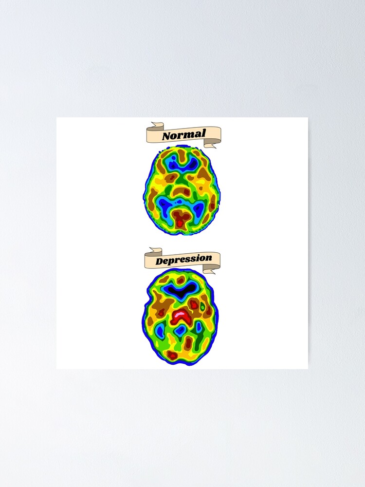 "Normal vs. Depressed brain scan" Poster for Sale by XLesserPandaX ...