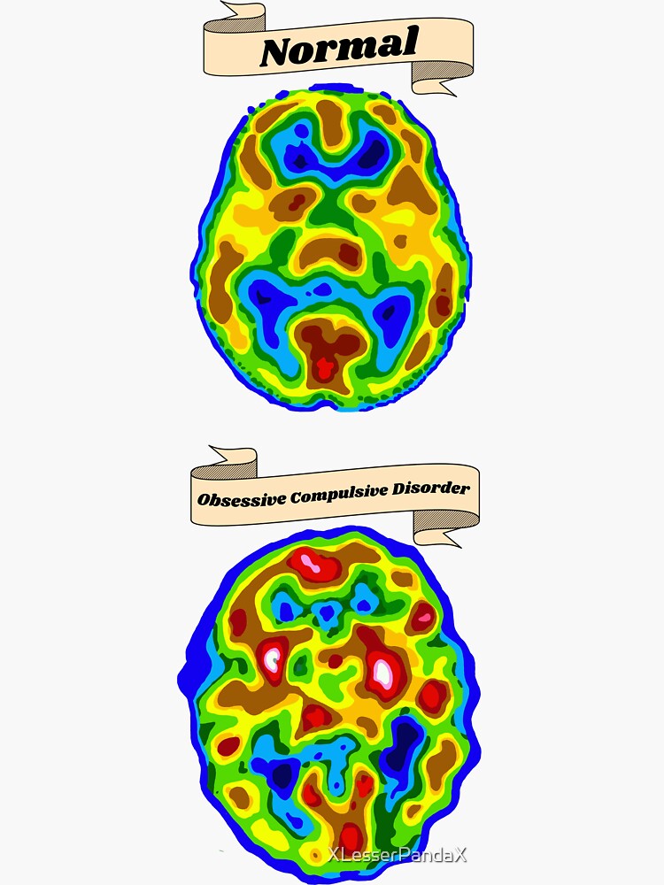 "Copy of Normal vs. OCD brain scan" Sticker for Sale by XLesserPandaX ...