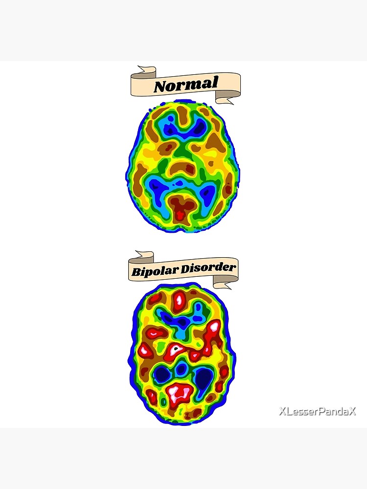 "Copy of Normal vs. Bipolar brain scan" Poster by XLesserPandaX | Redbubble