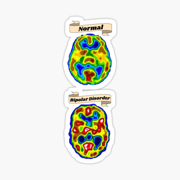 "Copy of Normal vs. Bipolar brain scan" Sticker for Sale by ...