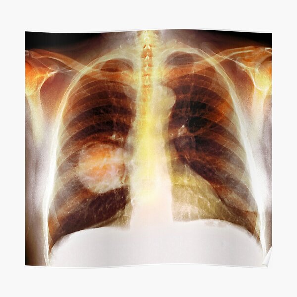 "Chest X-Ray" Poster for Sale by rcmarble | Redbubble