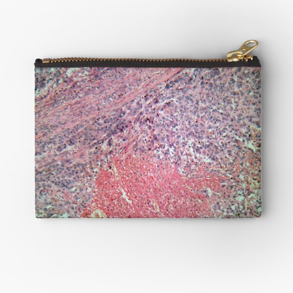 "Human skin with skin cancer under a microscope." Zipper Pouch for Sale ...