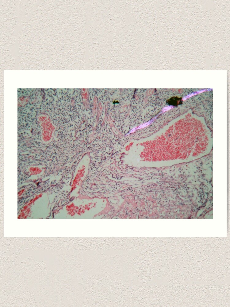 "Tissue cells from a human cervix with cervical cancer cells." Art ...