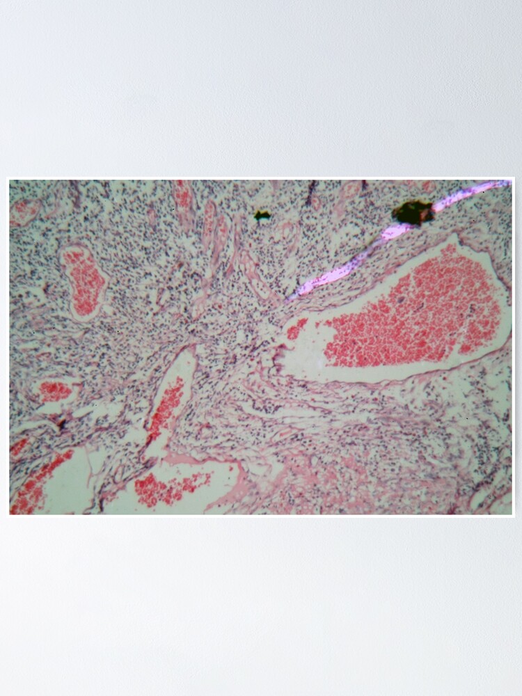 "Tissue cells from a human cervix with cervical cancer cells." Poster ...