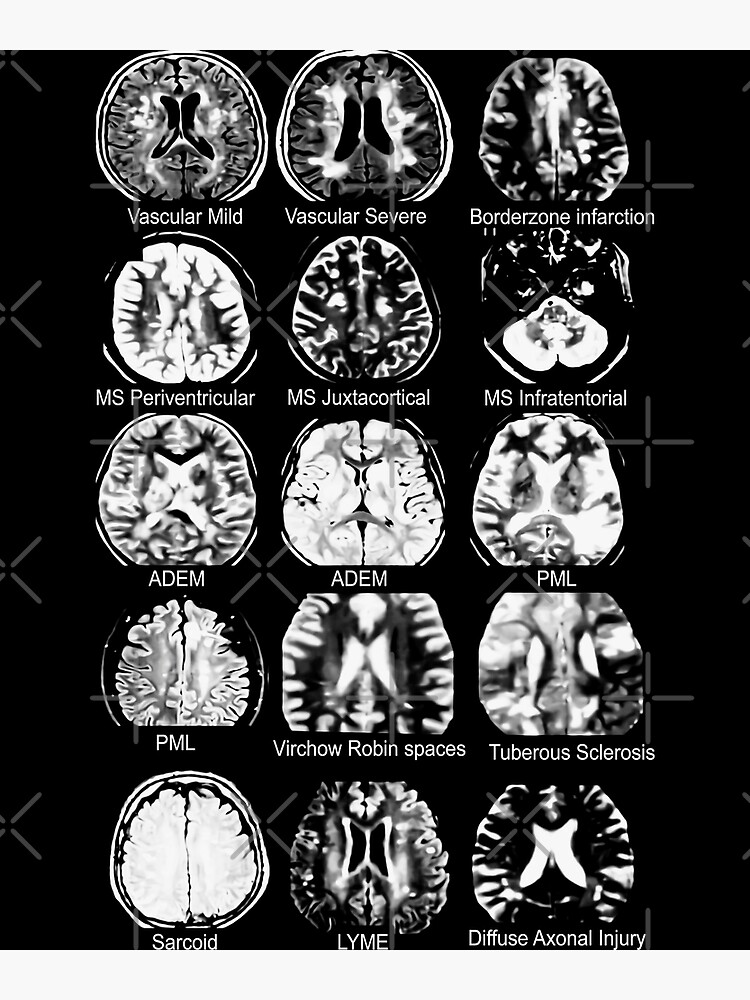 "Neurology Brain Dvhh Pml" Poster for Sale by AvaLavoie | Redbubble
