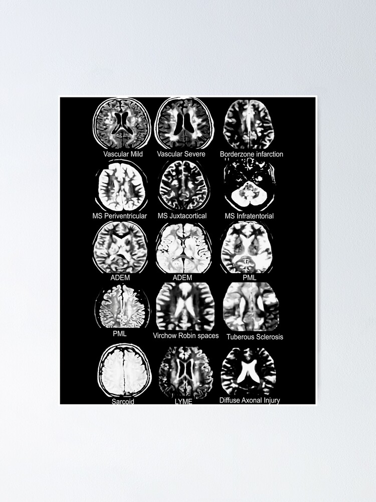 "Neurology Brain Dvhh Pml" Poster for Sale by AvaLavoie | Redbubble