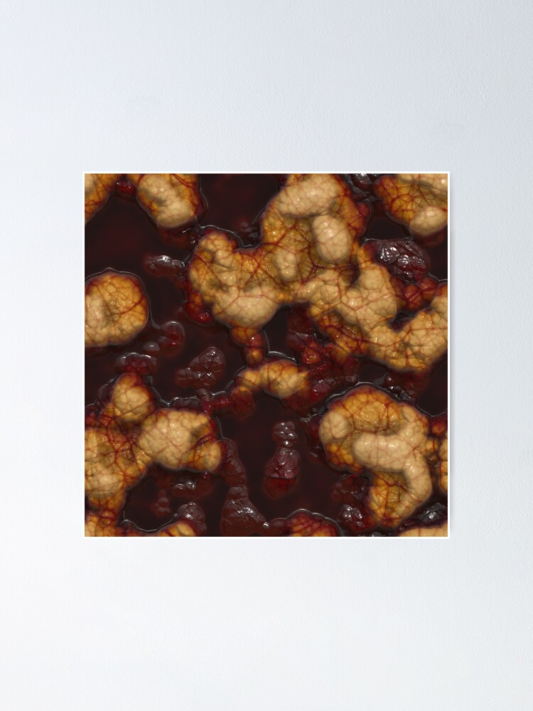 "Putrid Patterns - It’s Not A Tumour" Poster for Sale by James-Cole ...