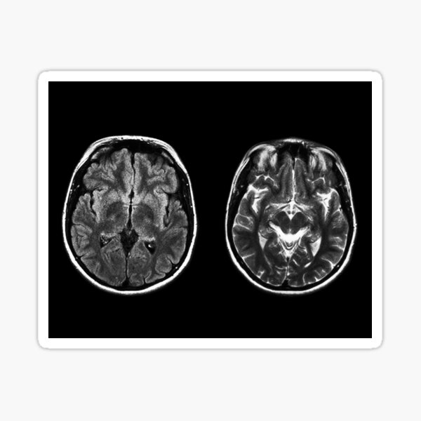 "Brain MRI x-ray" Sticker for Sale by gmstockstudio | Redbubble