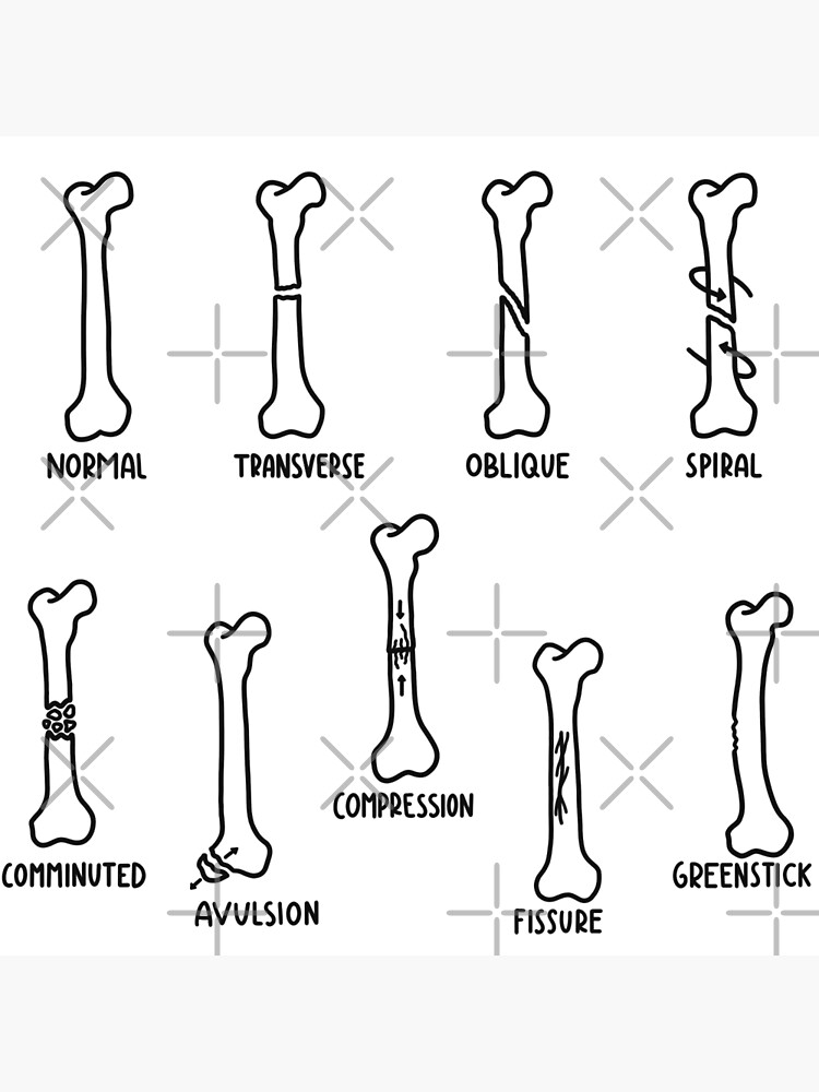 "Hand Drawn Types of Fractures In Black" Poster by SofiaSava01 | Redbubble