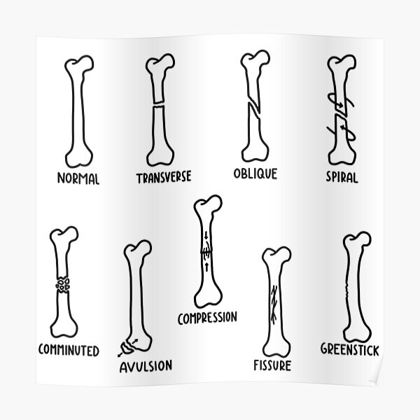 "Hand Drawn Types of Fractures In Black" Poster by SofiaSava01 | Redbubble