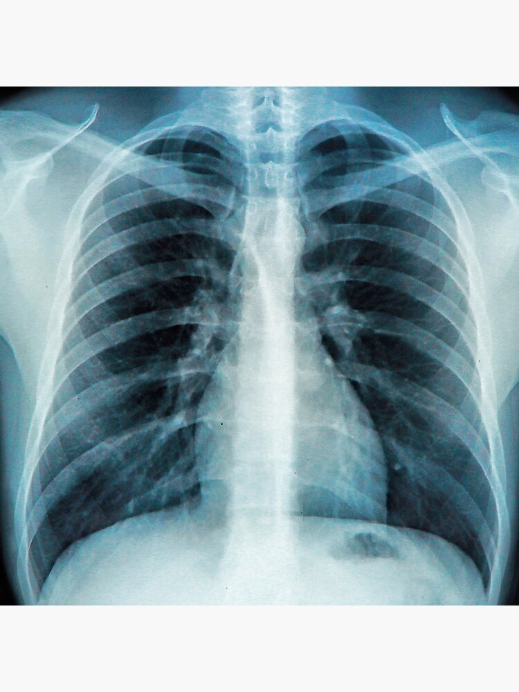 Anatomía Del Tórax Por Rayos X ABC Radiografía De Tórax