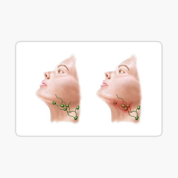 "Anatomy of swollen lymph nodes." Sticker for Sale by StocktrekImages ...