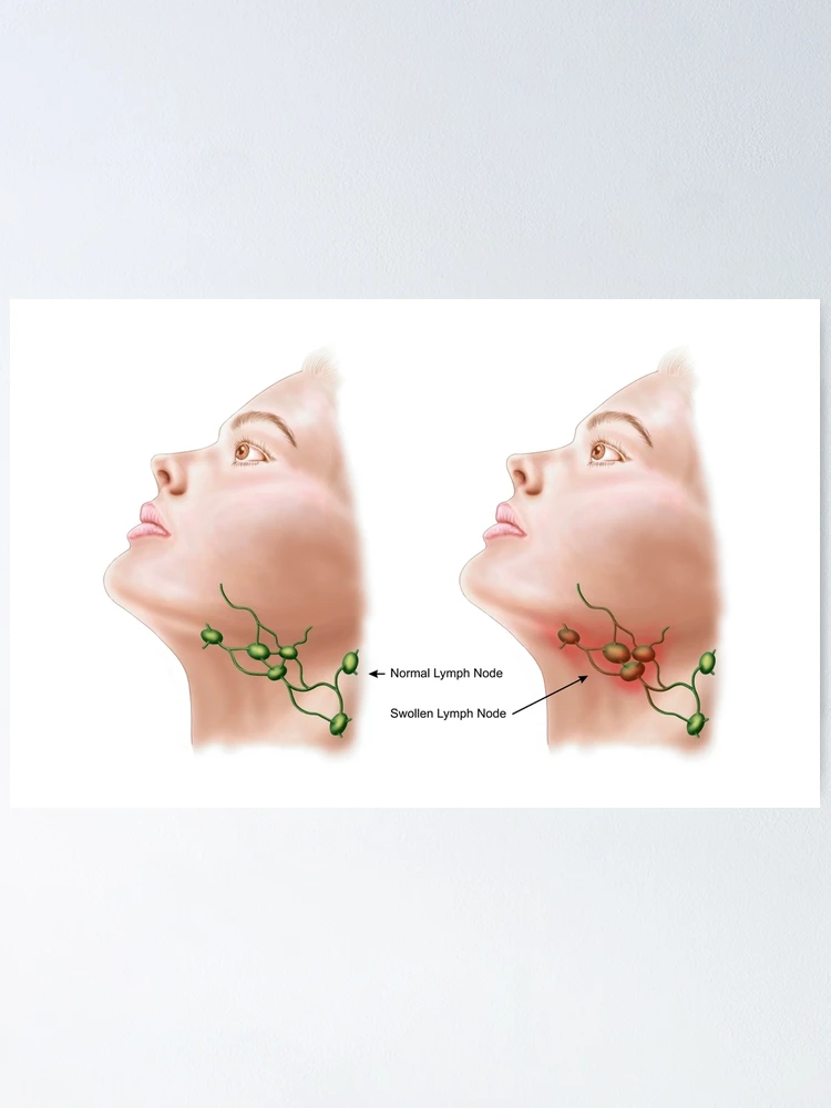 Swollen Lymph Nodes Diagram