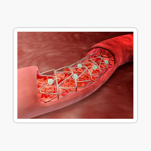 "Artery cross-section with blood flow and stent deployment." Sticker ...