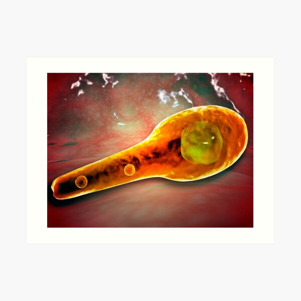 Tetanus Art Prints | Redbubble