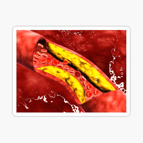 "Microscopic view of fat plaque inside the artery." Sticker by ...