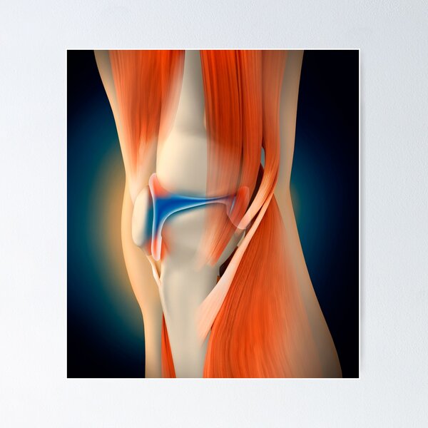 "STK700542H-Medical illustration showing inflammation in human knee ...