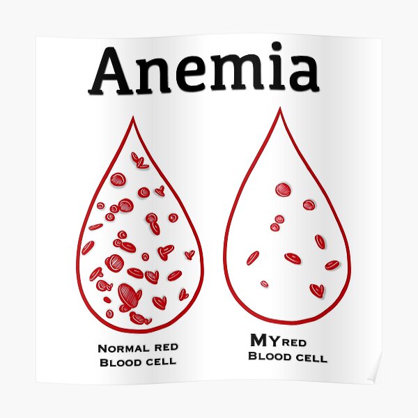 "Iron deficiency anemia" Poster for Sale by veravervain | Redbubble