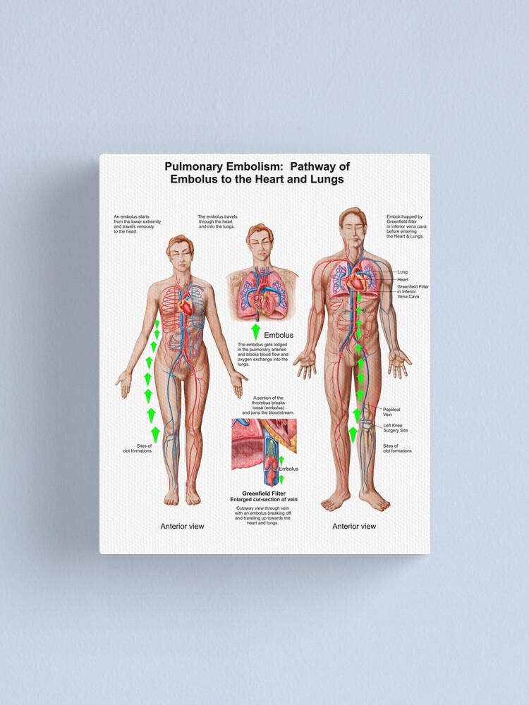 "Pulmonary embolism, pathway of embolus to the heart and lungs." Canvas ...