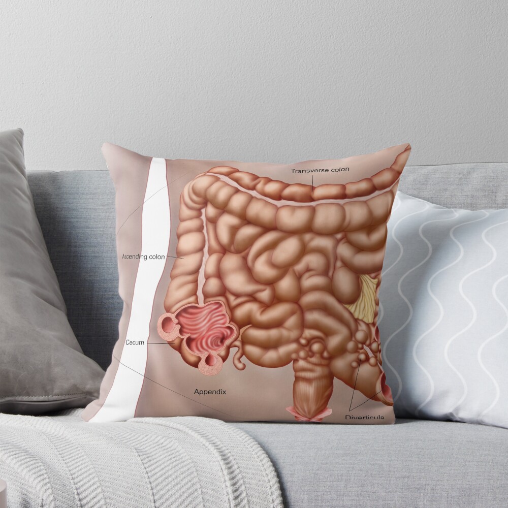 "Diverticulitis in the descending colon region of the human intestine ...