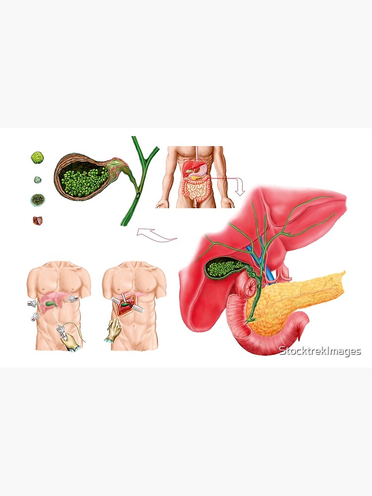 "Illustration depicting cholecystectomy, the surgical removal of the ...